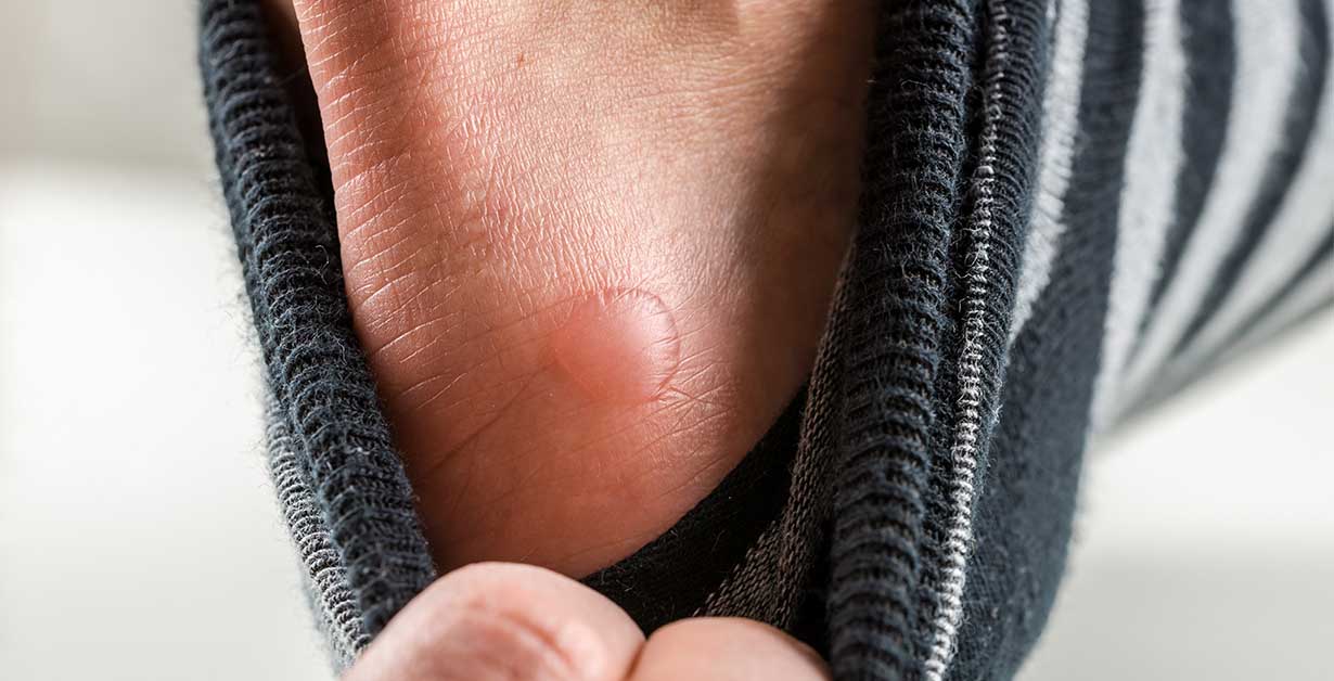 How to Treat a Blister: Managing Bug Bites, Chemical Exposure, and More